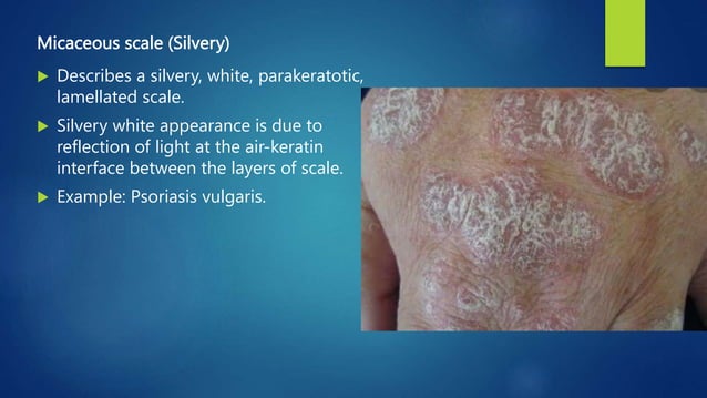 Scaly signs in dermatology. Article discussion | PPTX