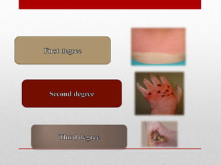 Types of skin burns | PPTX