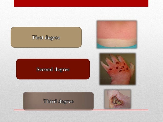 Types of skin burns