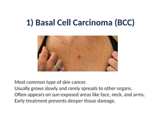Types of Skin Cancers: Awareness, Detection, and Prevention | PPTX