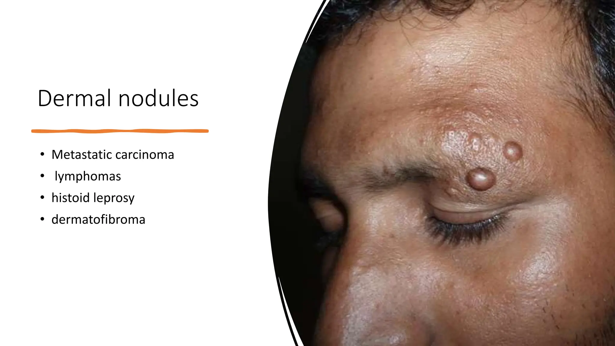 Clinical Classification of Skin Lesions: A Morphological Approach in ...