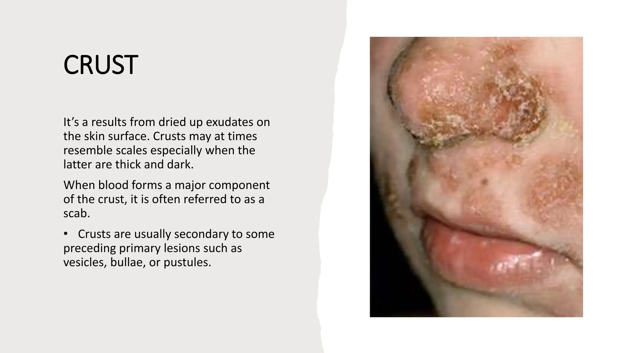 Clinical Classification of Skin Lesions: A Morphological Approach in ...