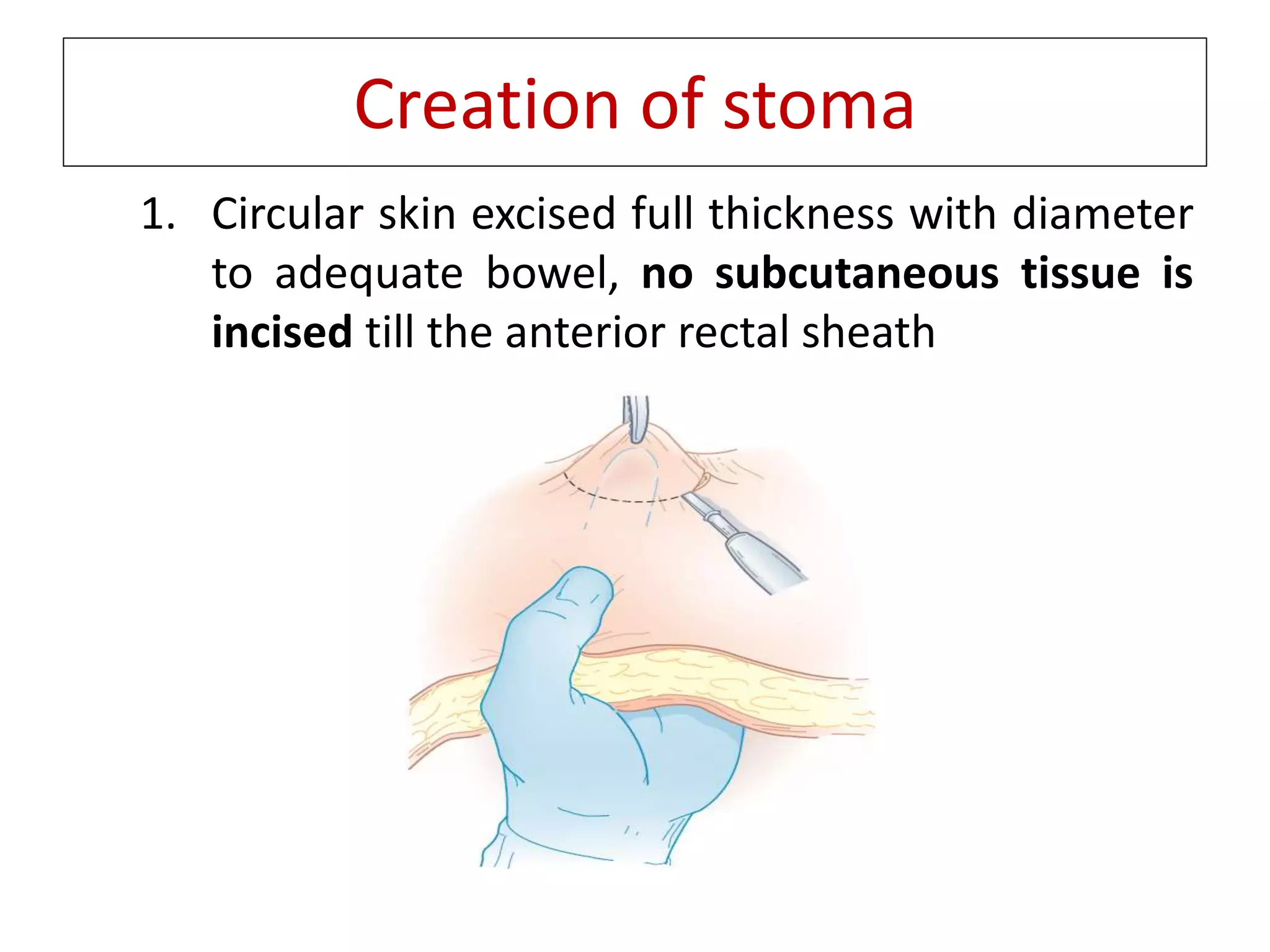 Types of intestinal stomas and management | PPTX