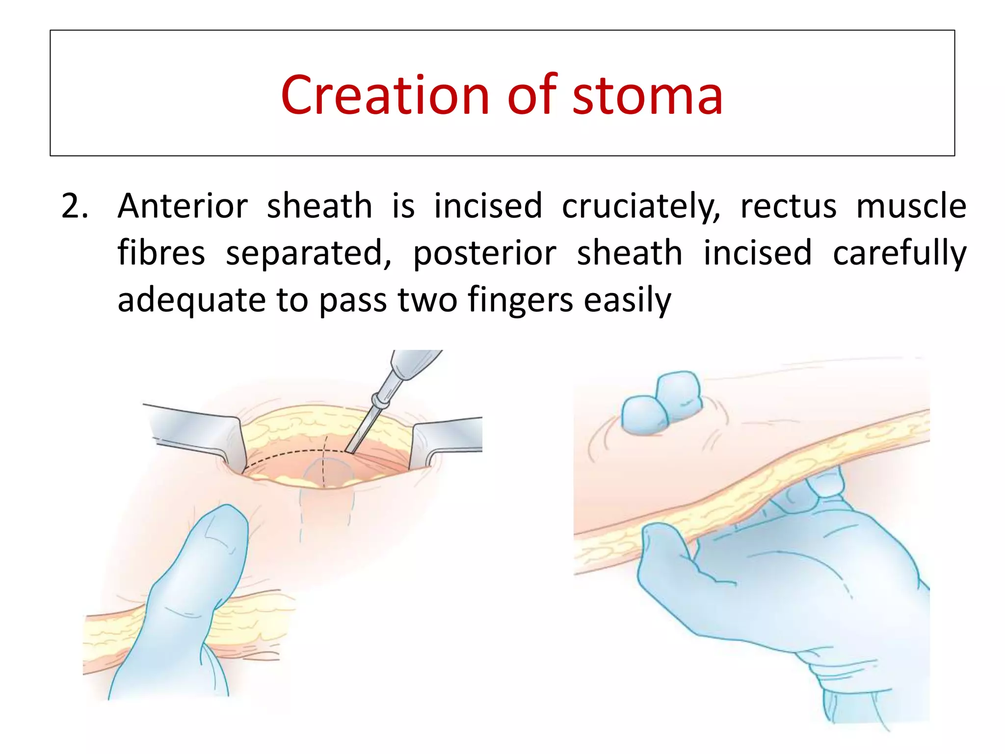 Types of intestinal stomas and management | PPTX