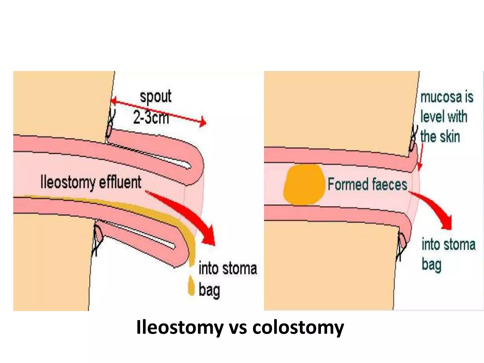Types of intestinal stomas and management | PPTX