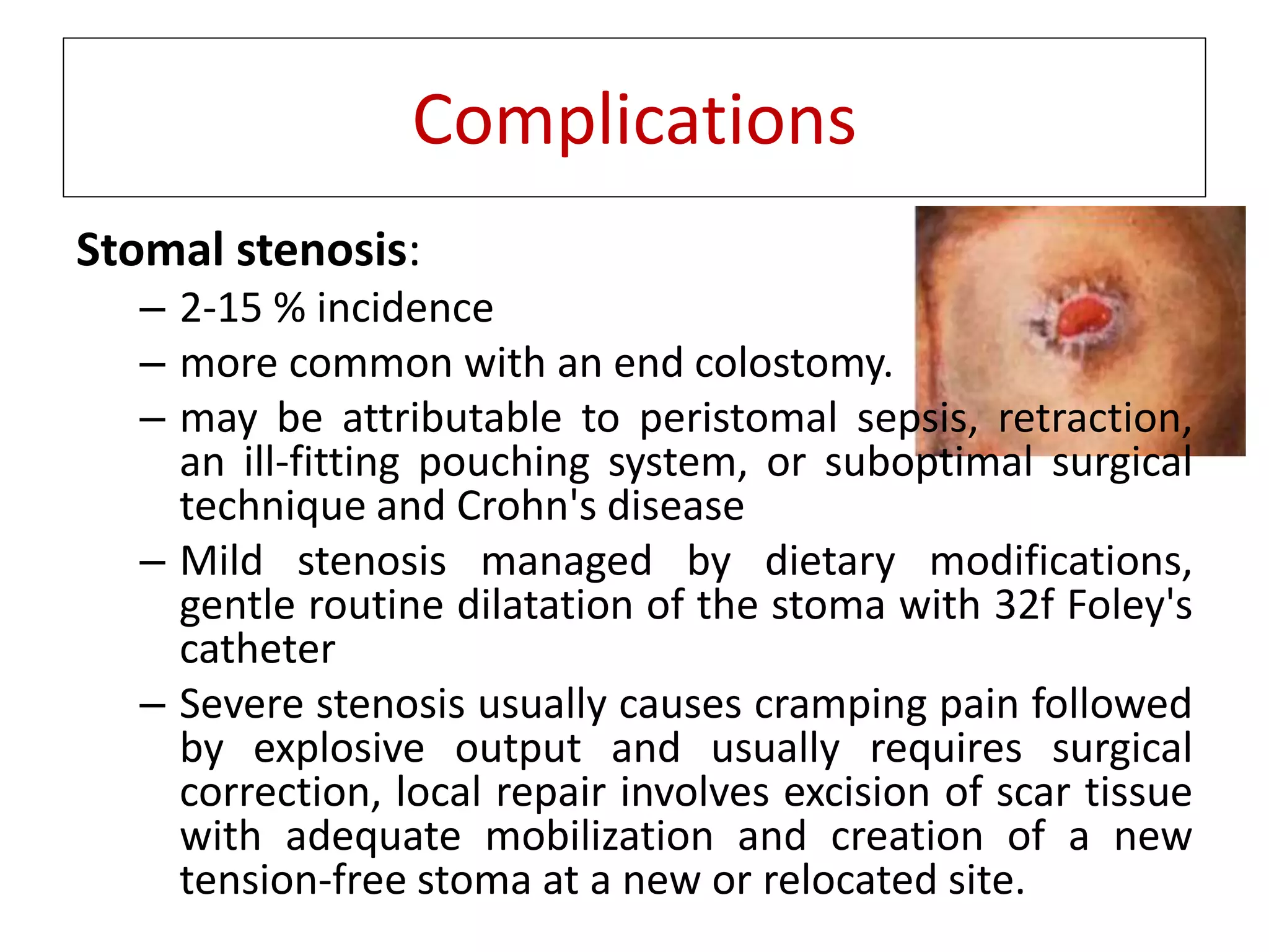 Types of intestinal stomas and management | PPTX