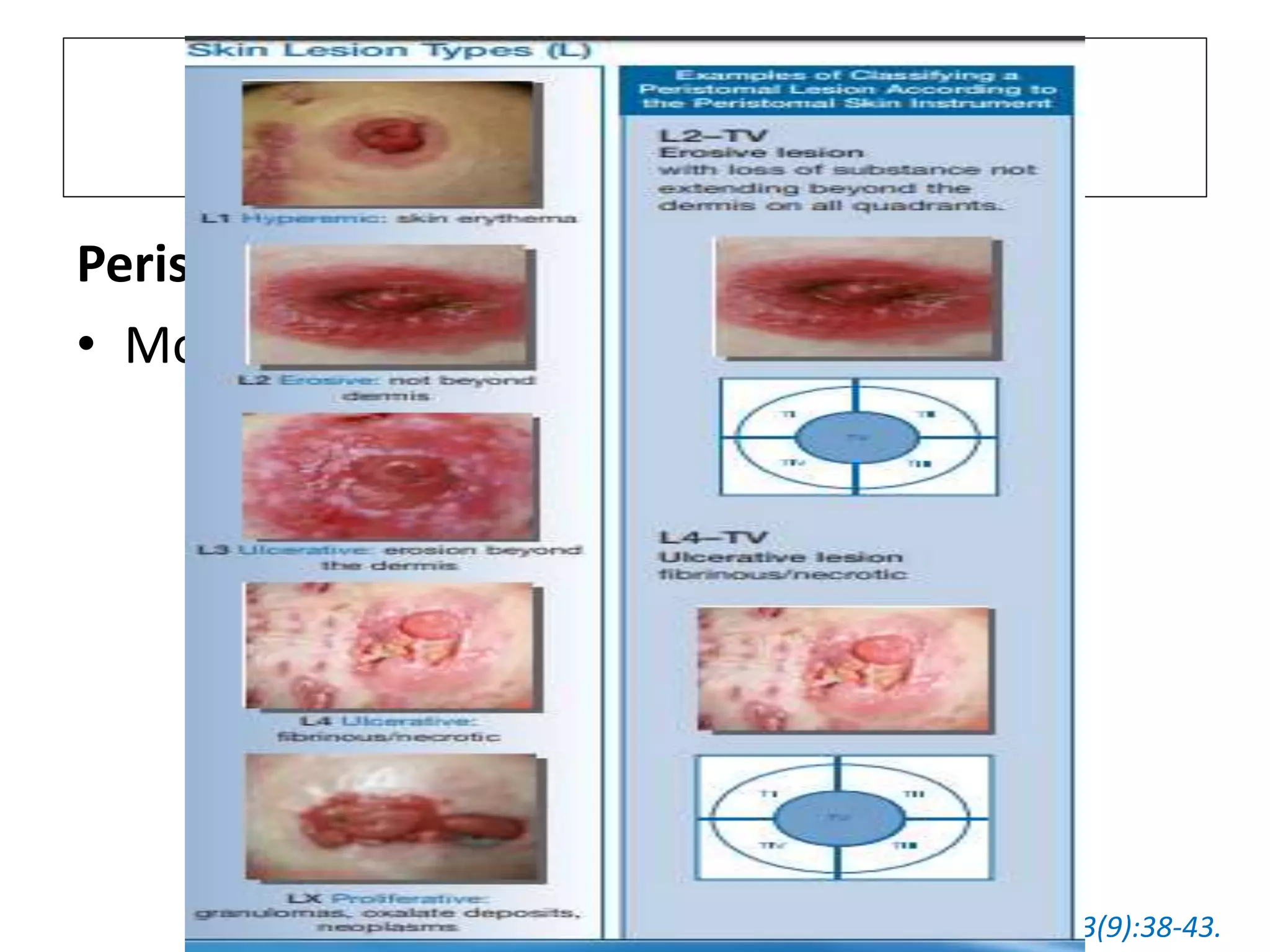 Types of intestinal stomas and management | PPTX