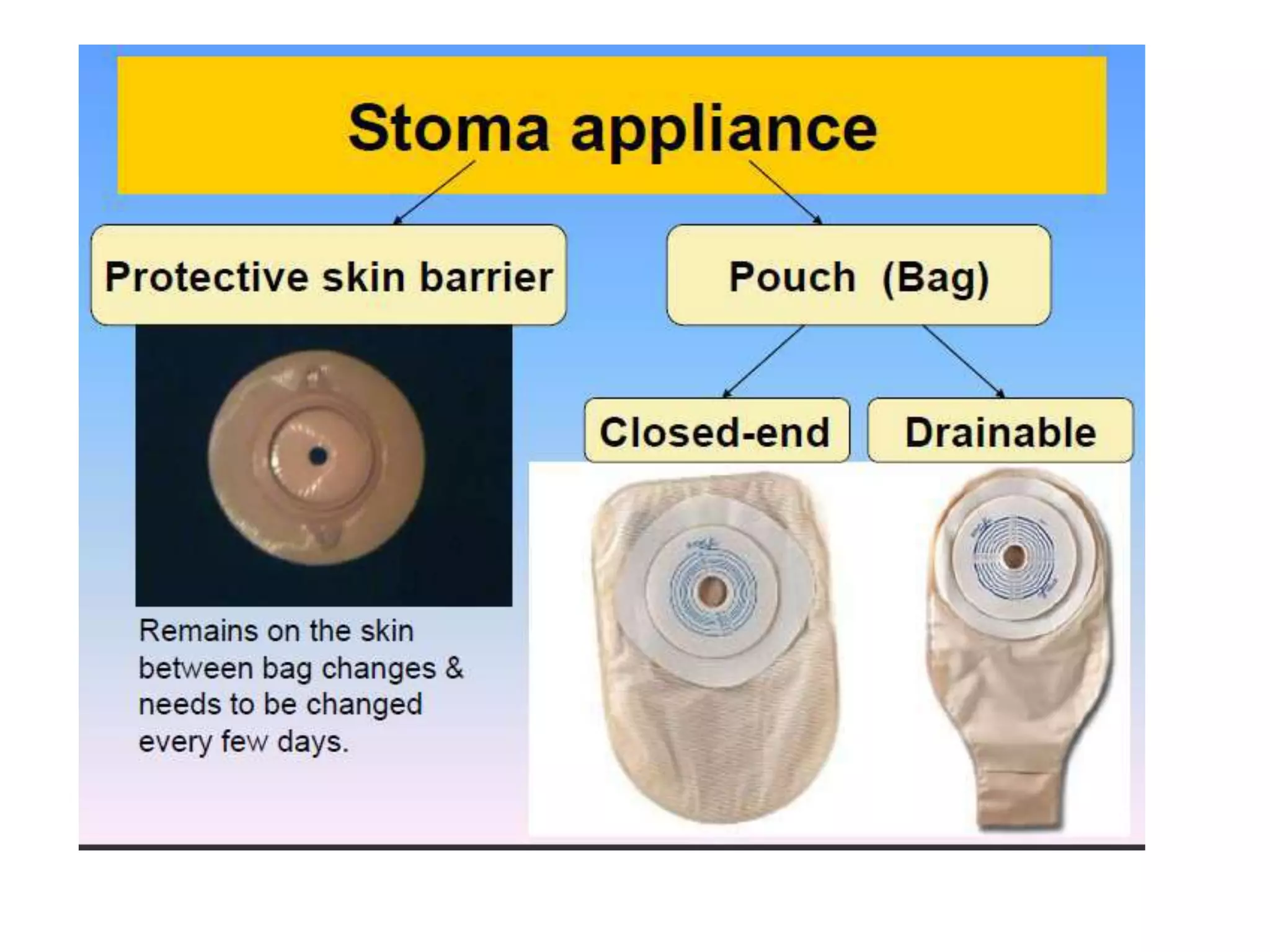 Types of intestinal stomas and management | PPTX