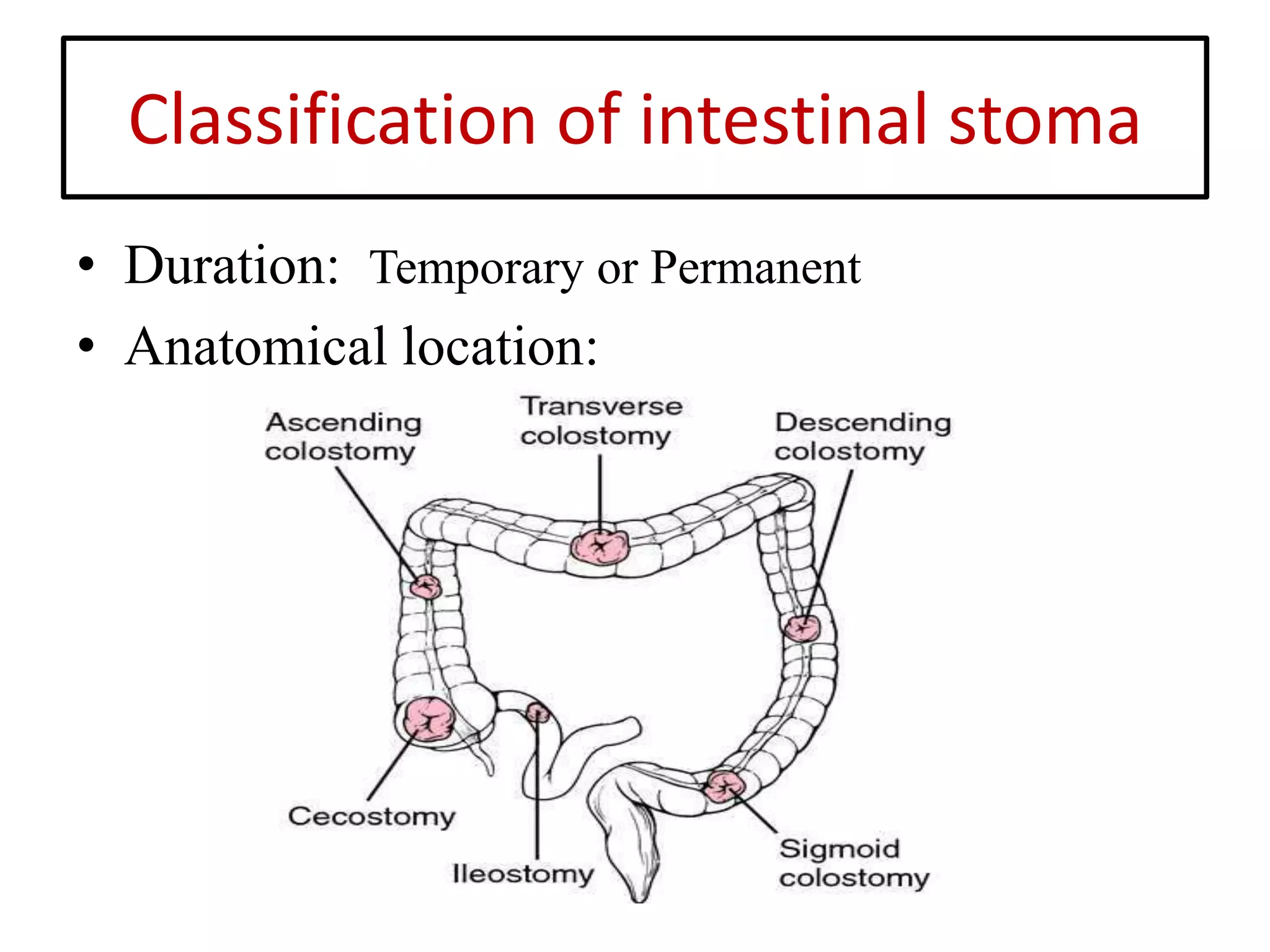 Types of intestinal stomas and management | PPTX