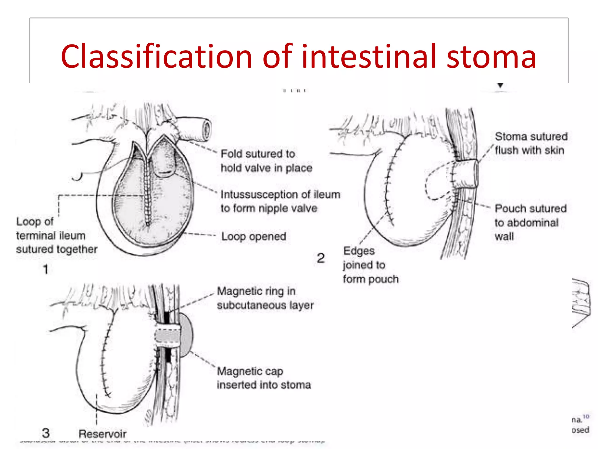 Types of intestinal stomas and management | PPTX