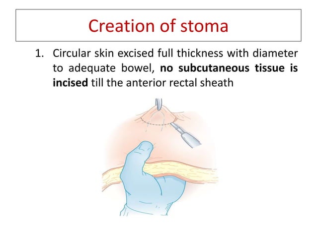 Types of intestinal stomas and management | PPTX