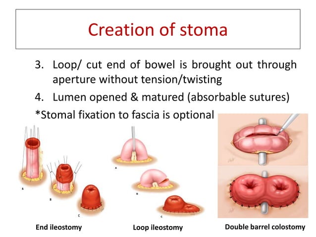 Types of intestinal stomas and management | PPTX