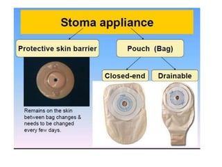 Types of intestinal stomas and management | PPTX