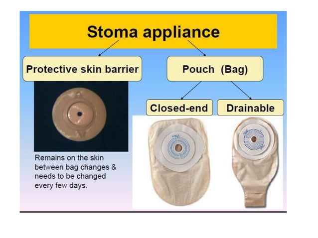 Types of intestinal stomas and management | PPTX