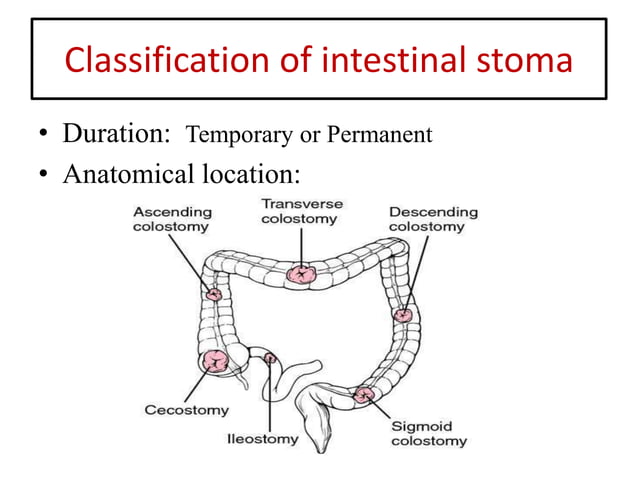 Types of intestinal stomas and management | PPTX