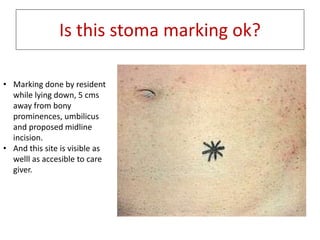 Types of intestinal stomas and management | PPTX