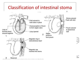 Types of intestinal stomas and management | PPT