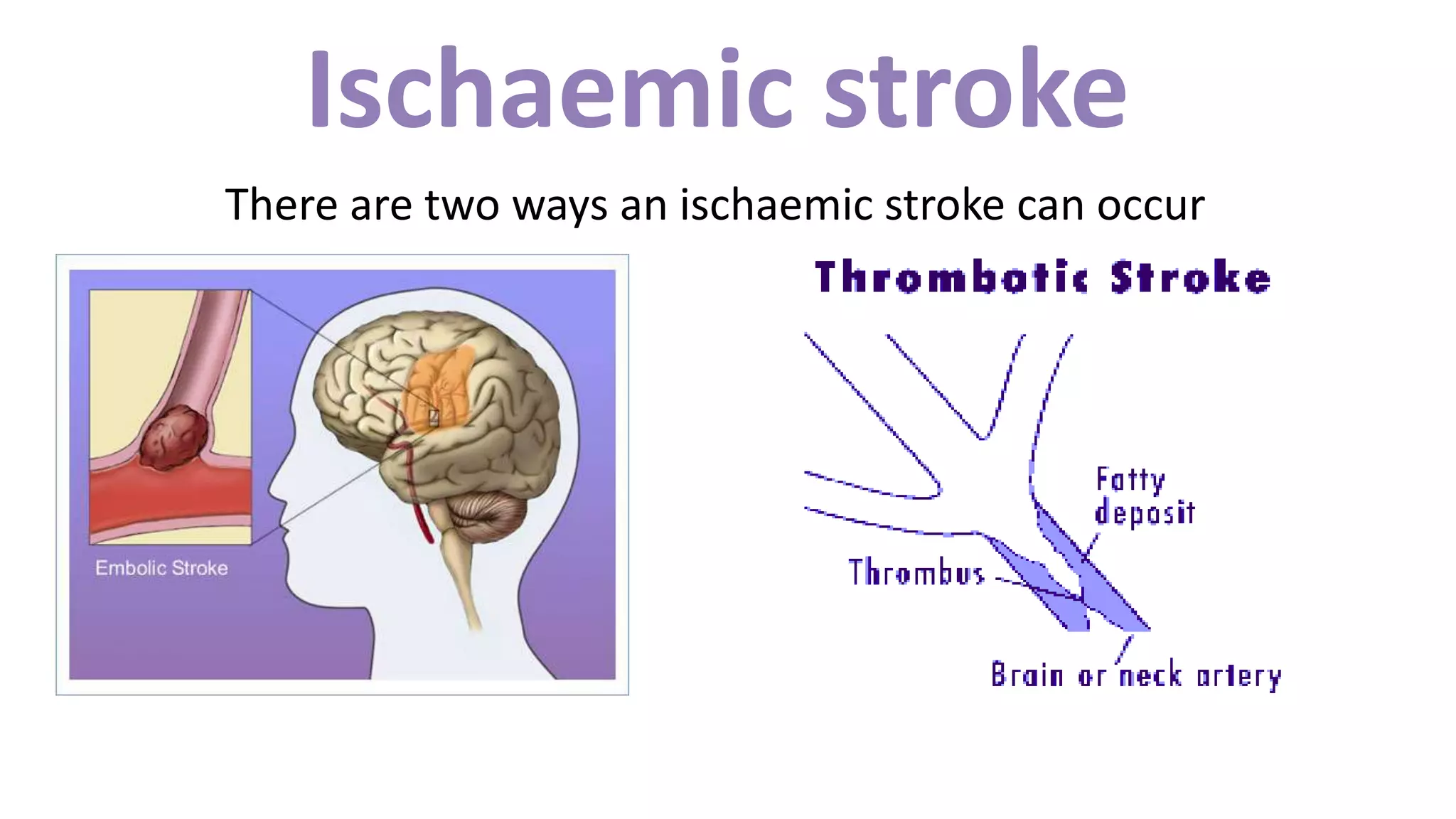 Types of strokes | PPTX