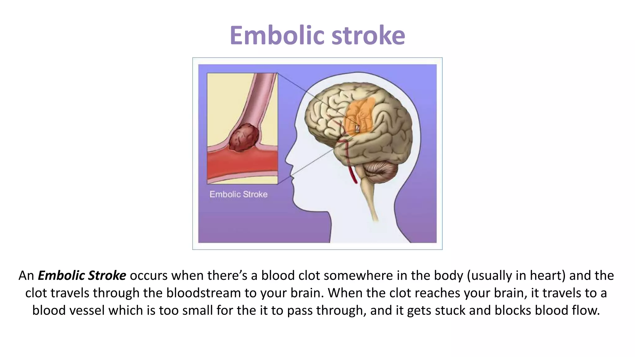 Types of strokes | PPTX