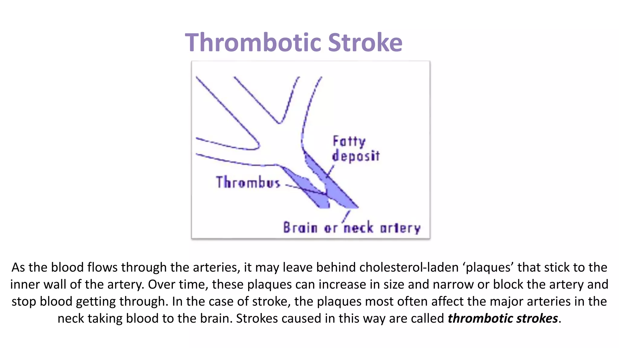 Types of strokes | PPTX