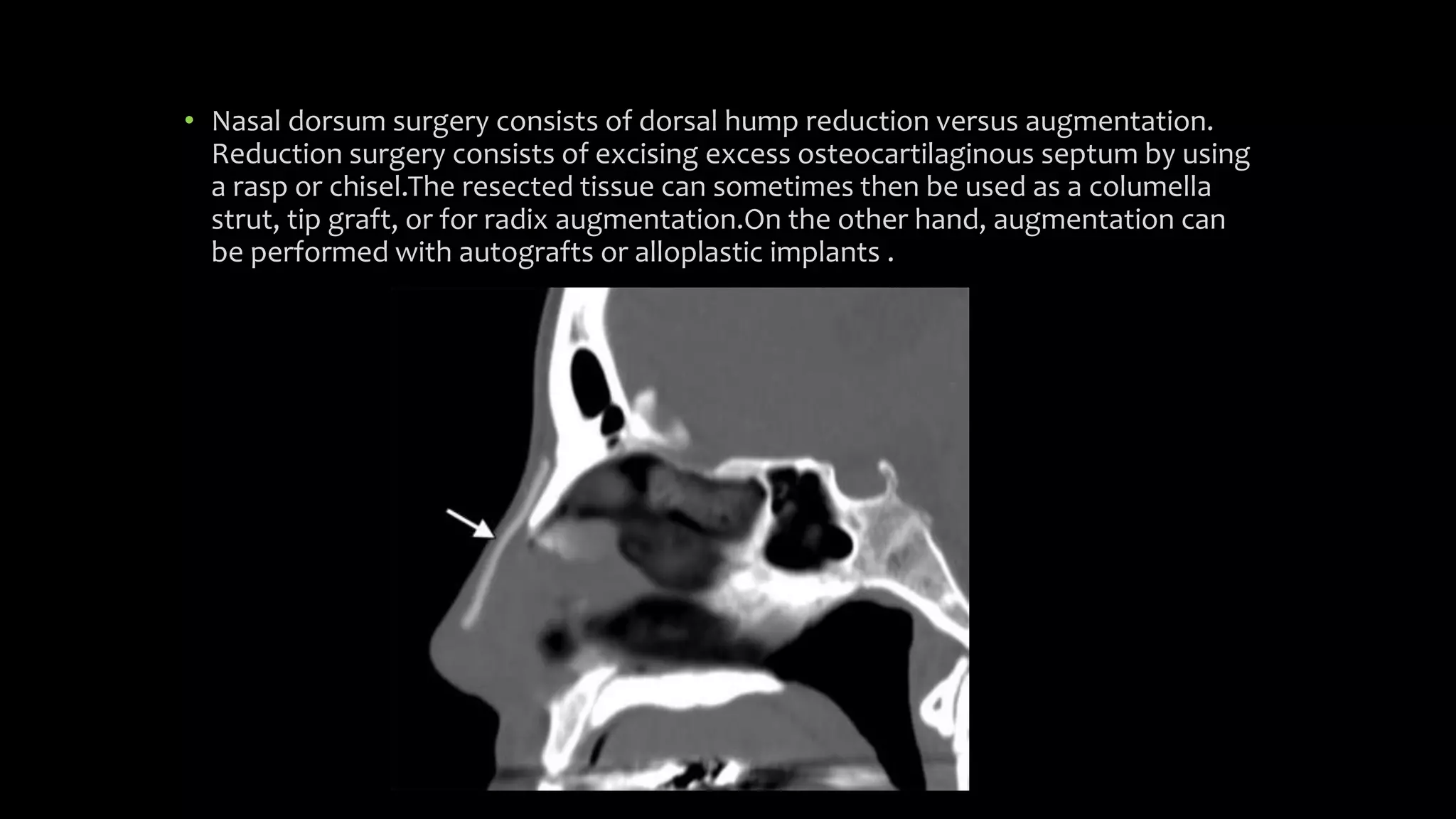 Types of surgery rhinoplasty | PPTX