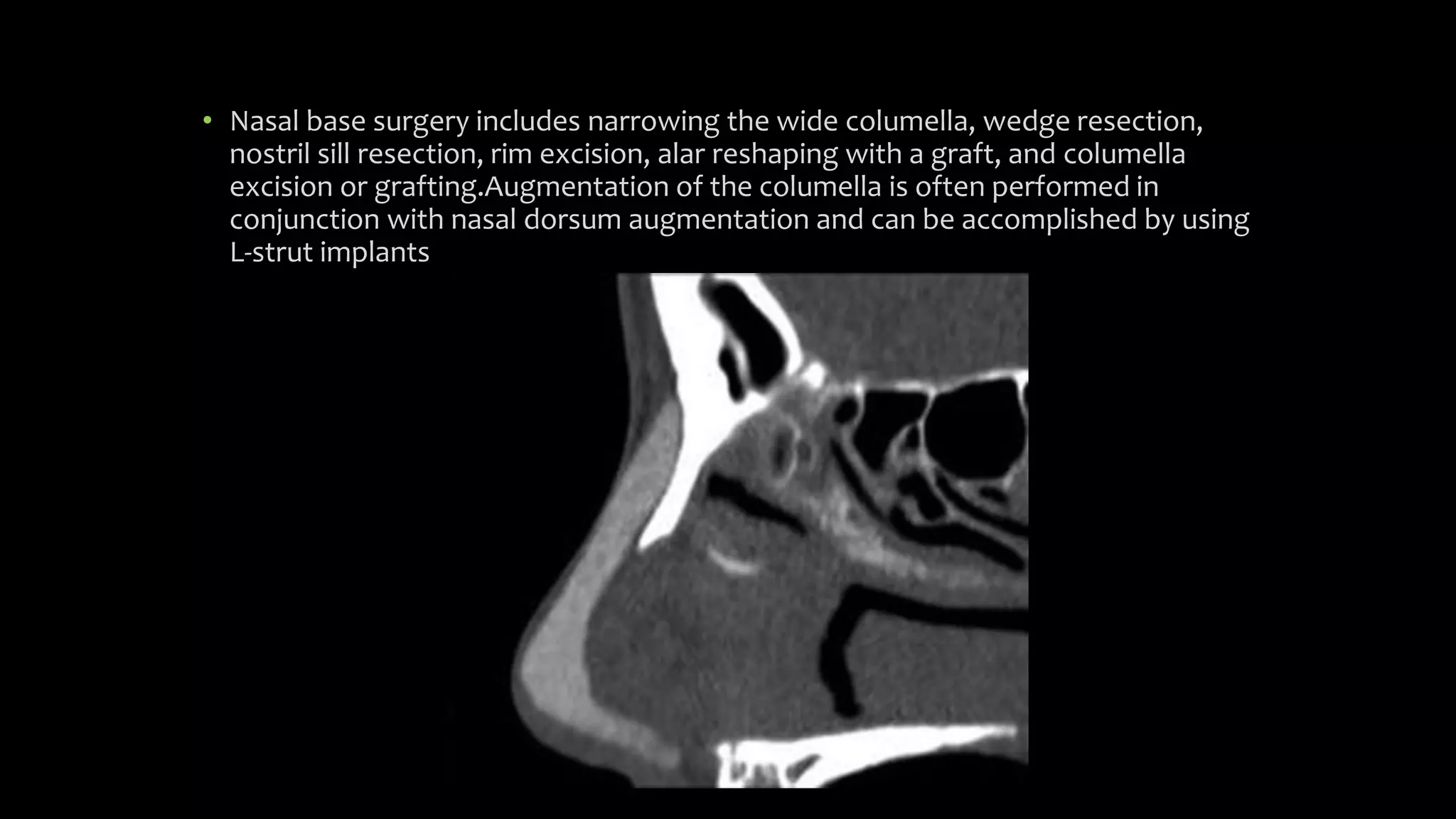 Types of surgery rhinoplasty | PPTX
