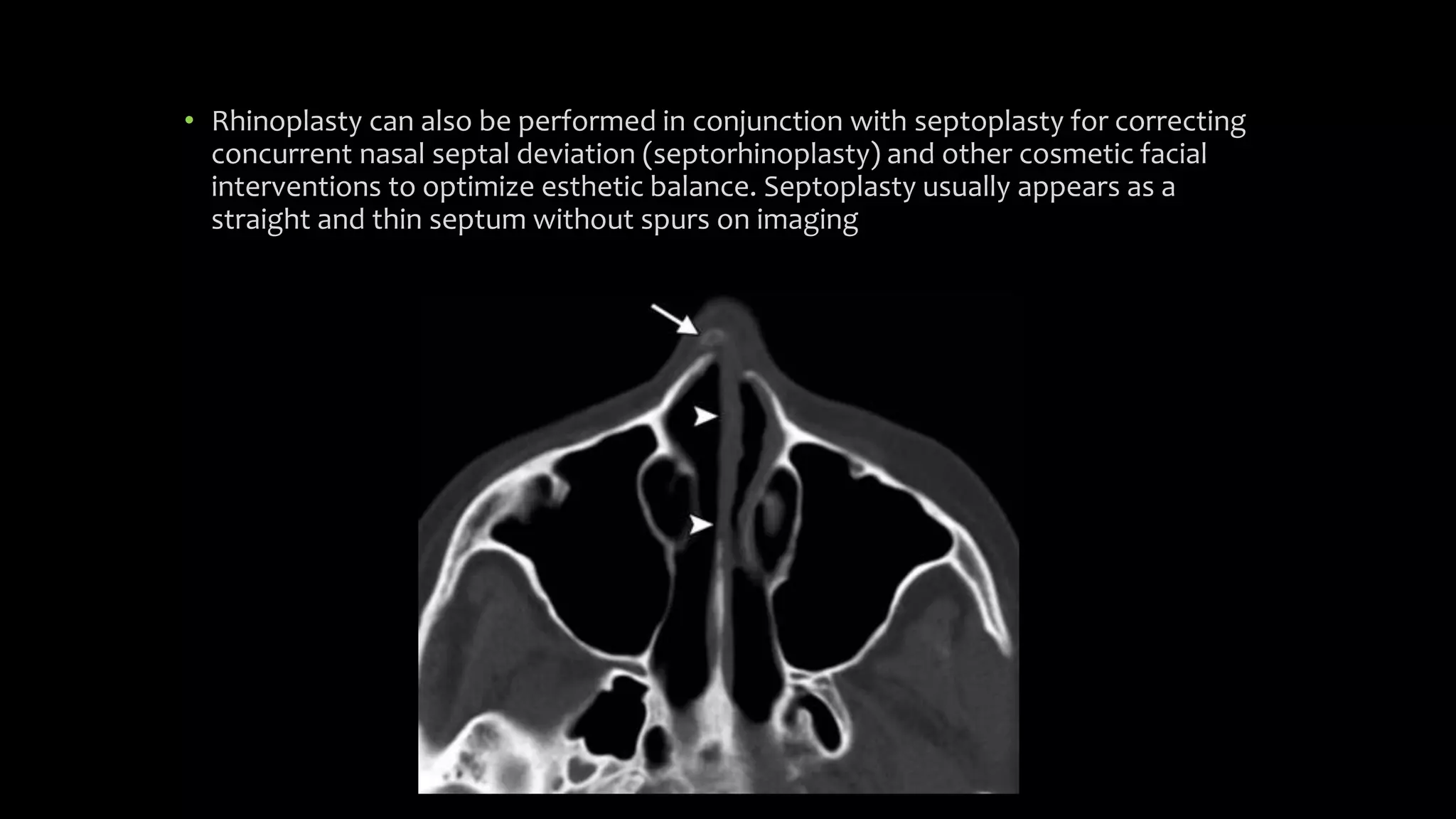 Types of surgery rhinoplasty | PPTX
