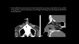 Types of surgery rhinoplasty | PPT