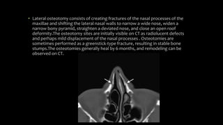 Types of surgery rhinoplasty | PPT
