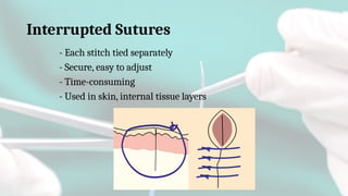TYPES OF SUTURES AND TECHNIQUE FOR CLINICAL PRACTICE.pptx