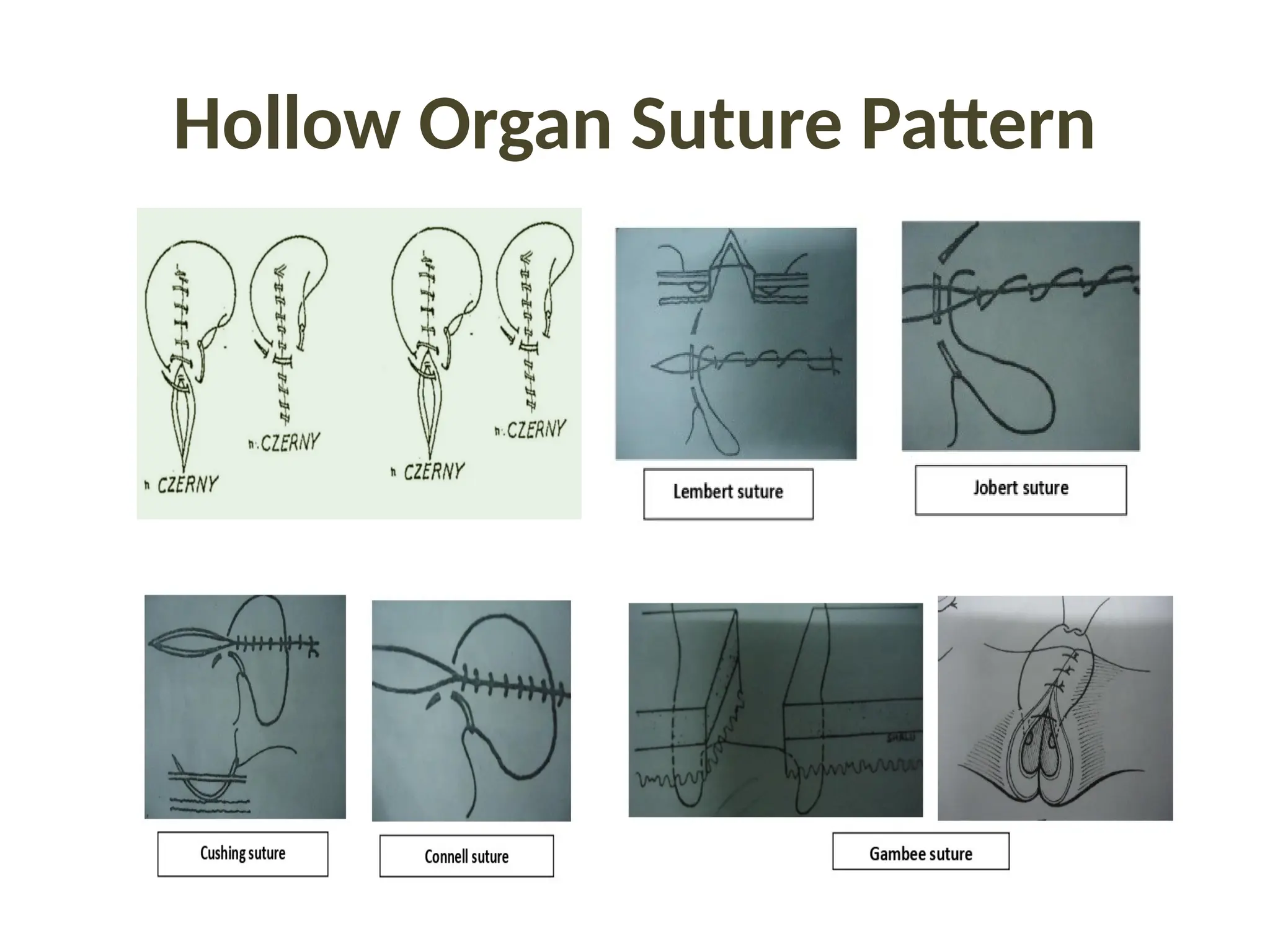 Types of suture used in different region of.pptx