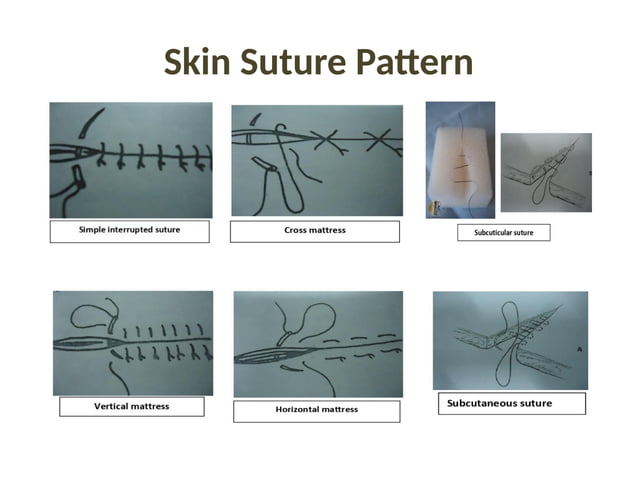 Types of suture used in different region of.pptx