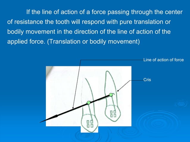 Types of tooth movement in orthodontics (4th BDS) | PPTX | Dental ...