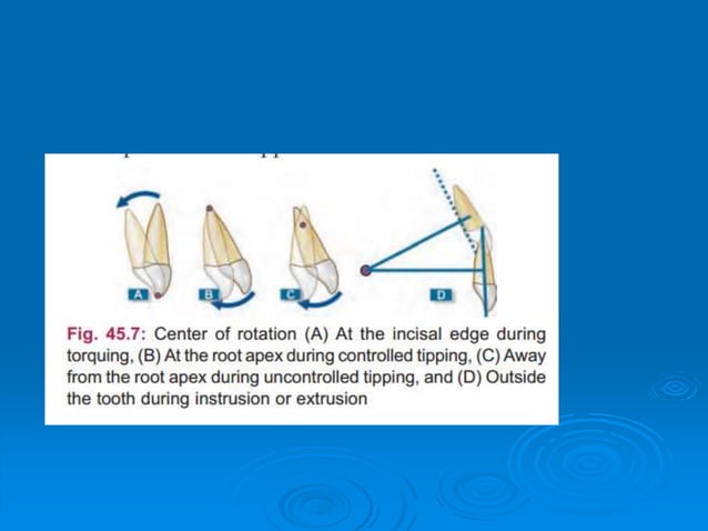Types of tooth movement in orthodontics (4th BDS) | PPTX | Dental ...