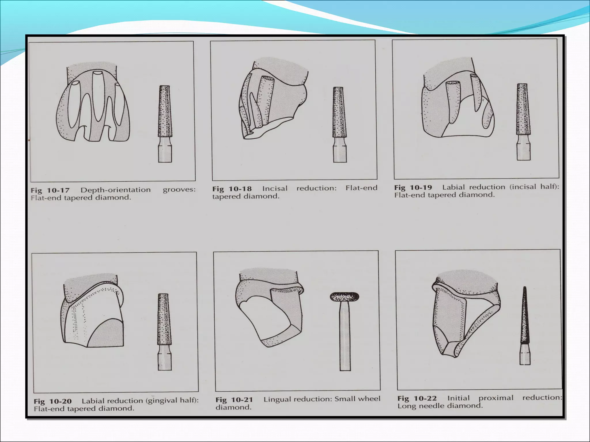 Types of tooth preparations | PPT