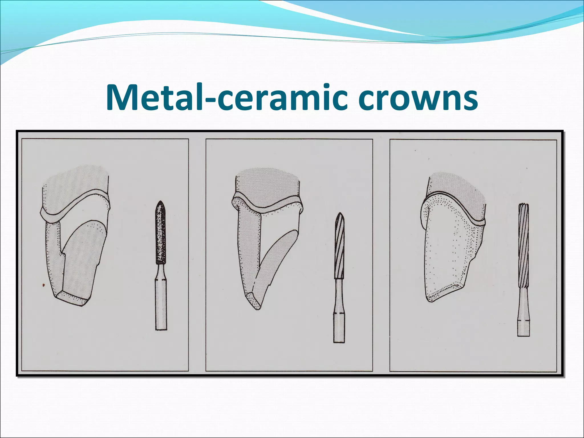 Types of tooth preparations | PPT