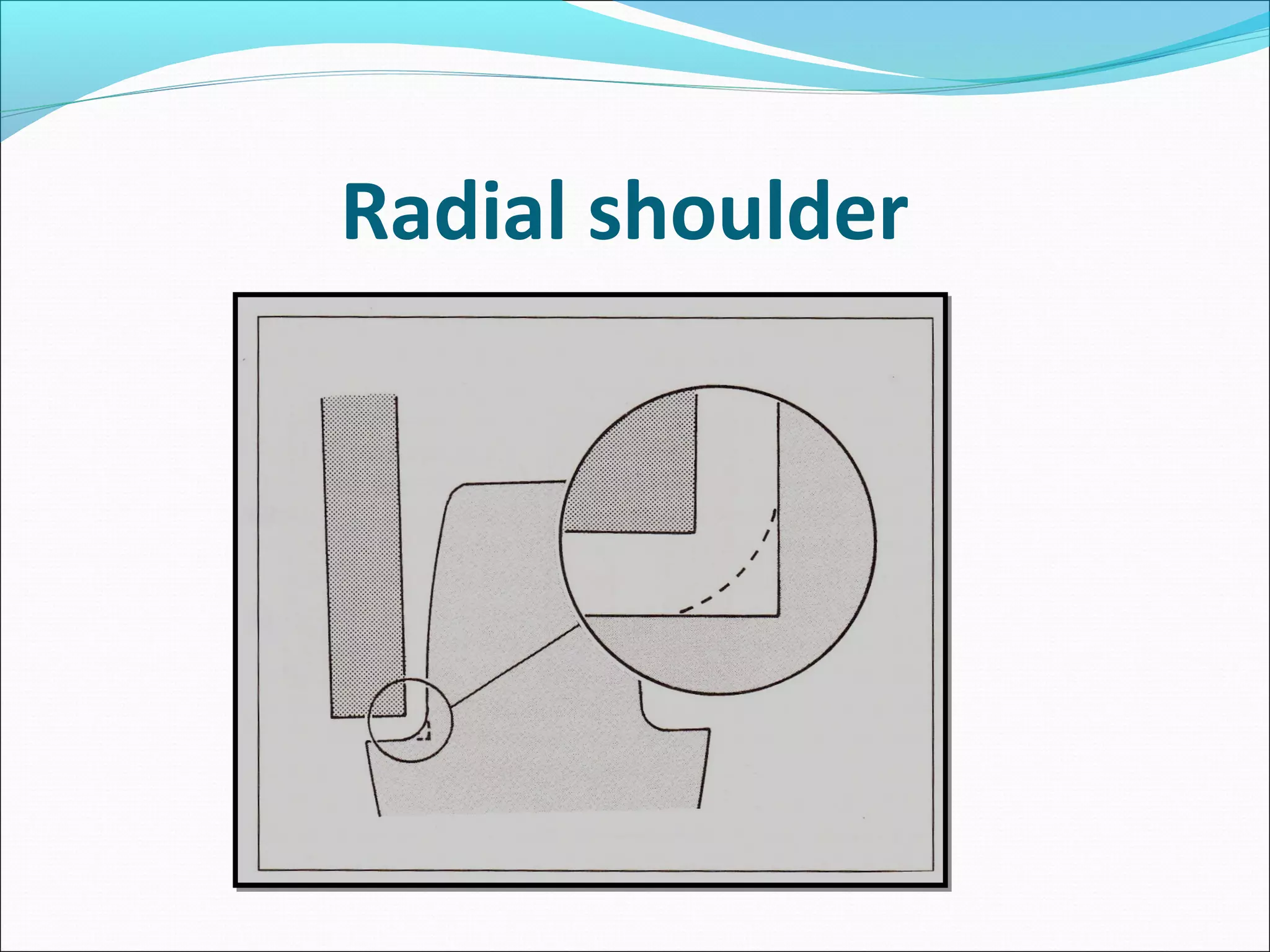 Types of tooth preparations | PPT