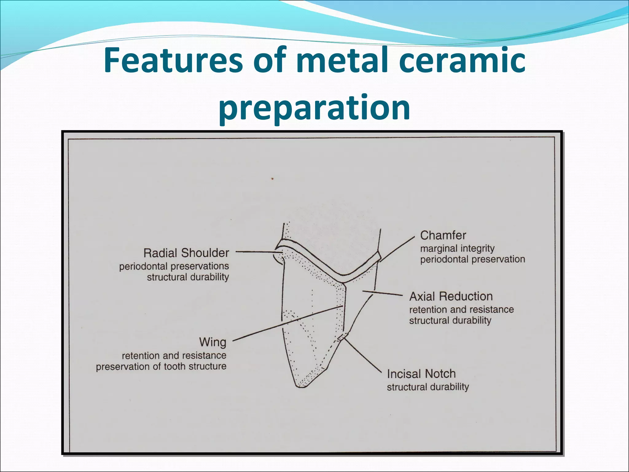 Types of tooth preparations | PPT