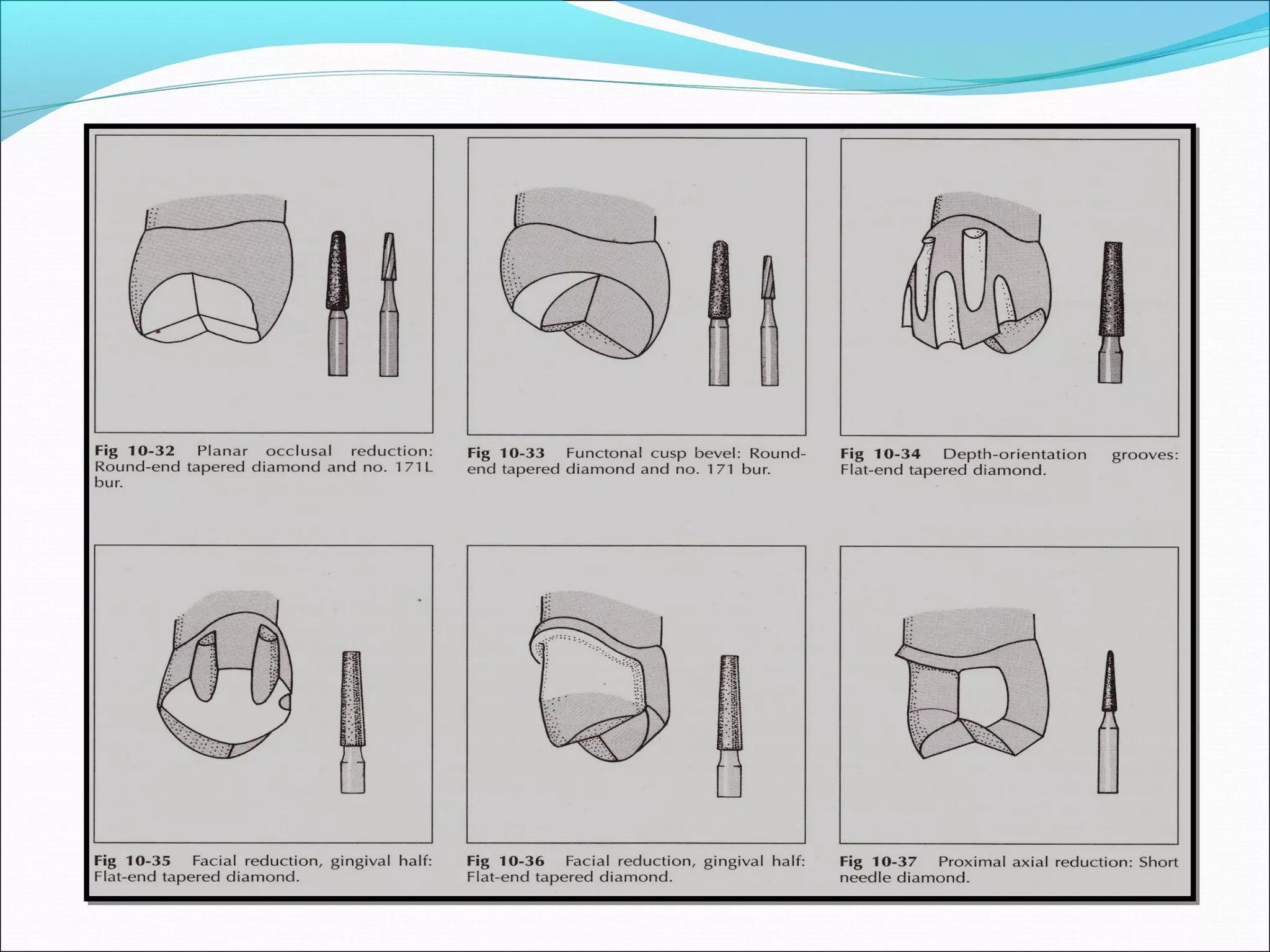 Types of tooth preparations | PPT