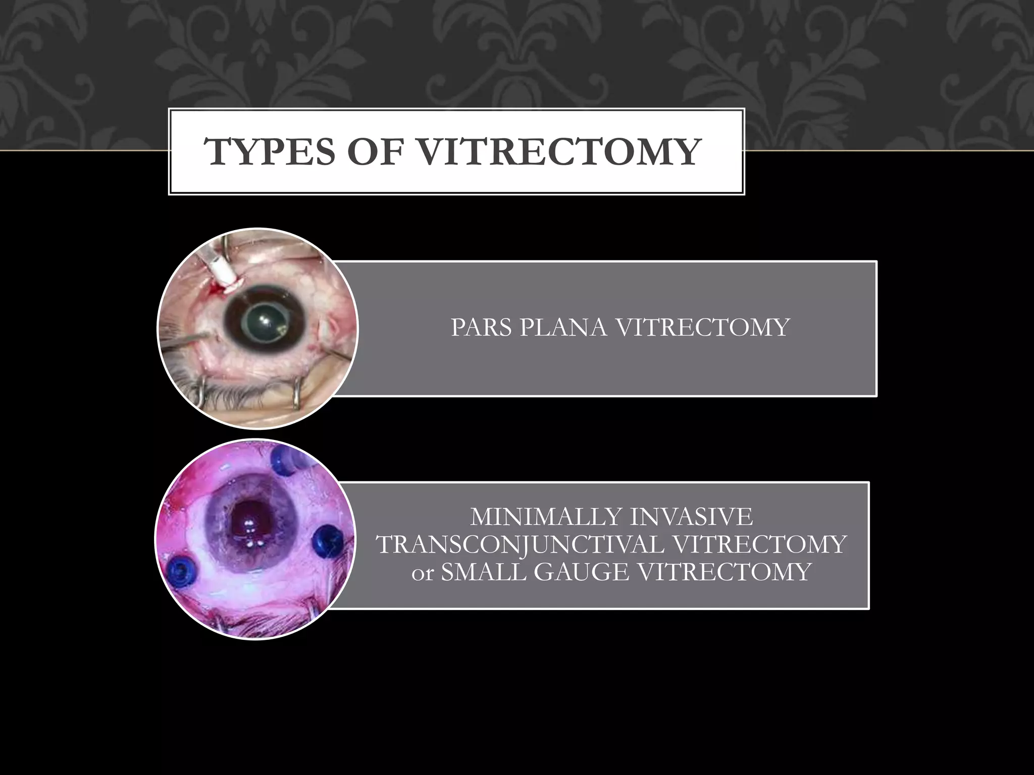 Types of vitrectomy ,indication s and complications | PPTX