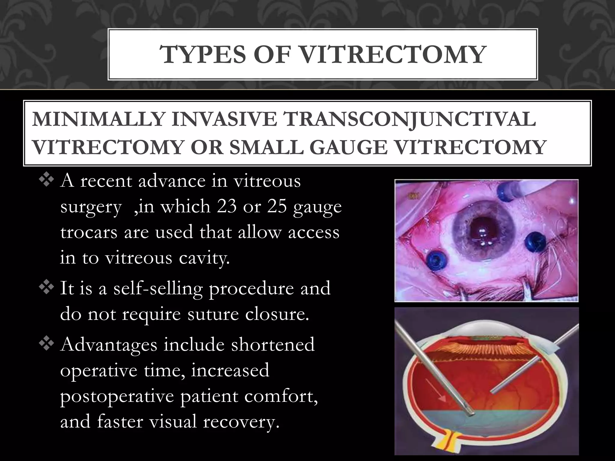 Types of vitrectomy ,indication s and complications | PPTX
