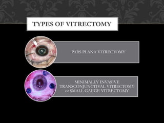Types of vitrectomy ,indication s and complications | PPTX