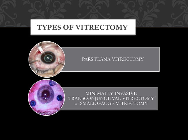 Types of vitrectomy ,indication s and complications | PPTX