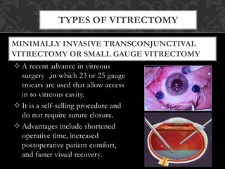 Types of vitrectomy ,indication s and complications | PPTX