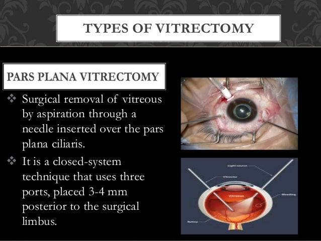 Types of vitrectomy ,indication s and complications