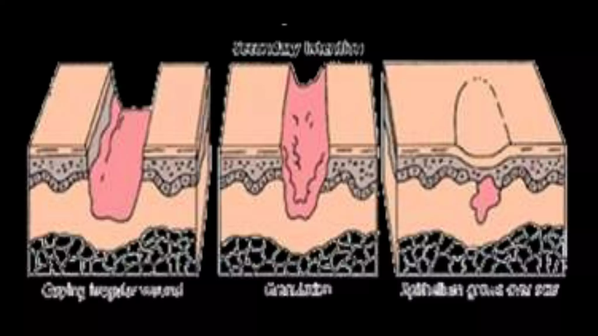 TYPES OF WOUND HEALING by Mishal Khan.pptx