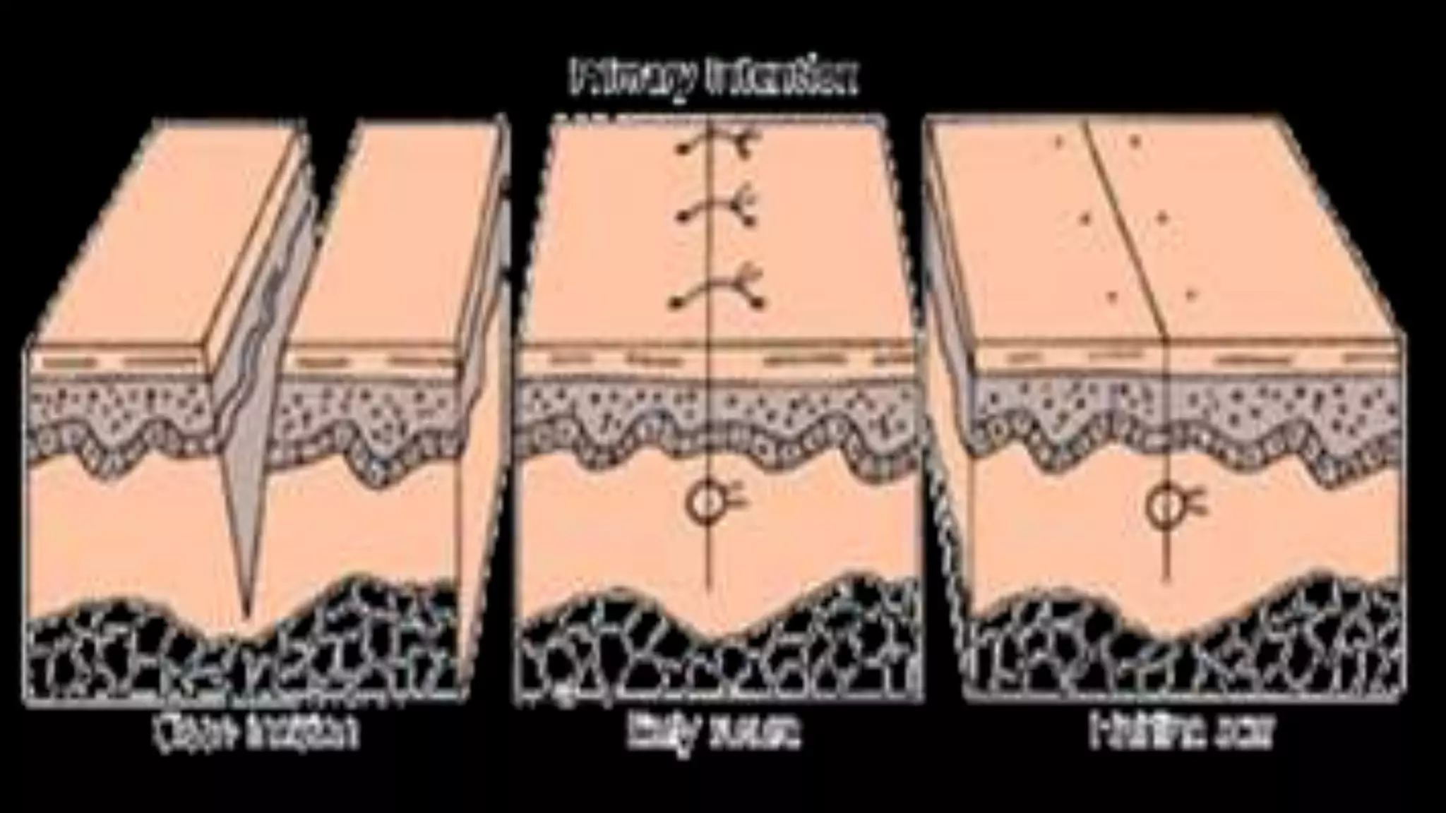 TYPES OF WOUND HEALING by Mishal Khan.pptx