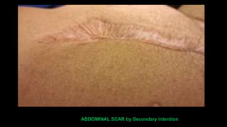 TYPES OF WOUND HEALING by Mishal Khan.pptx | Death, Injury, or Military ...