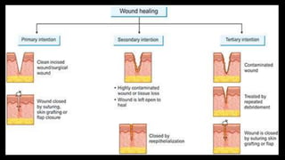 TYPES OF WOUND HEALING by Mishal Khan.pptx