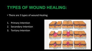 TYPES OF WOUND HEALING by Mishal Khan.pptx | Death, Injury, or Military ...